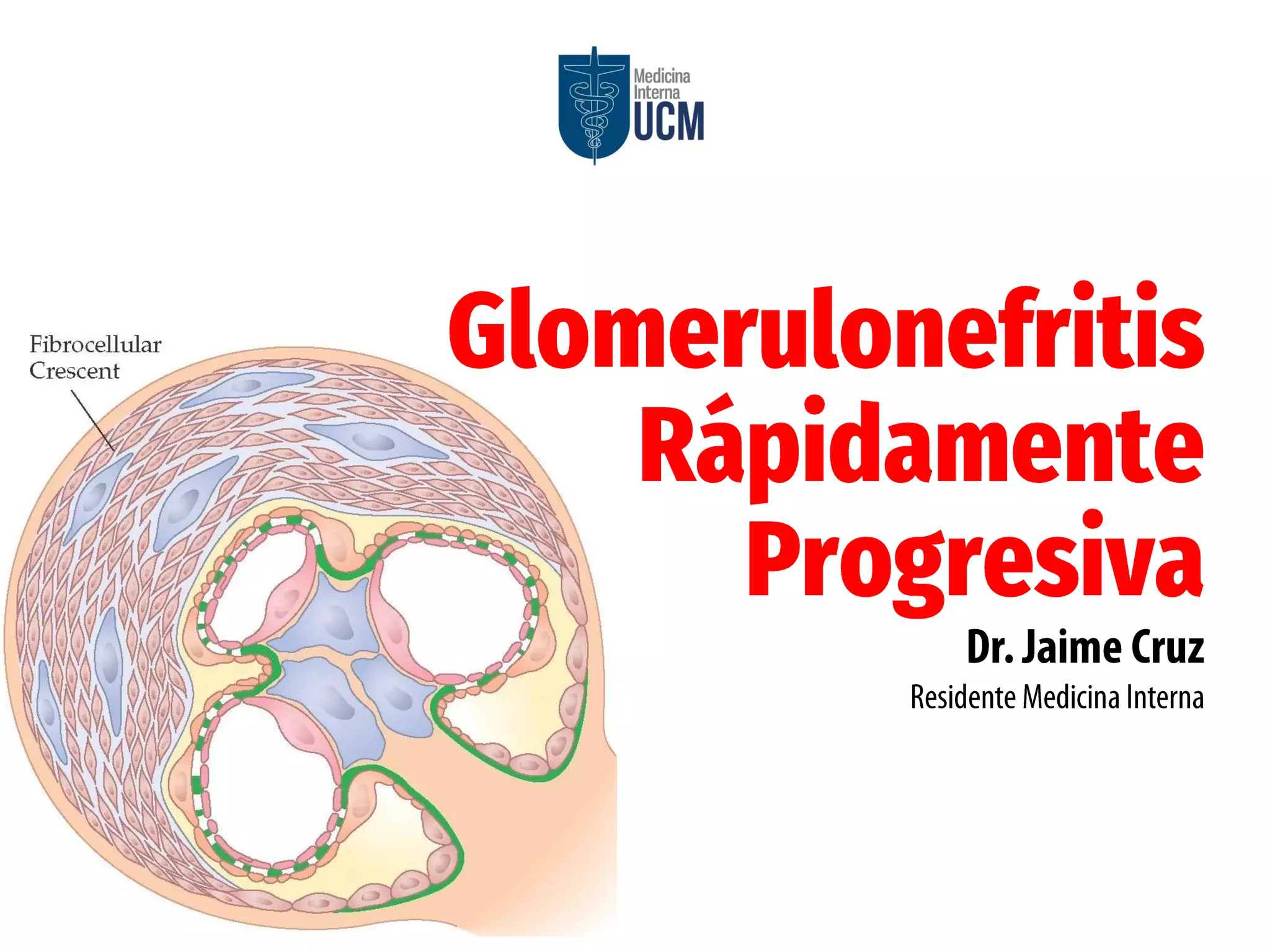 Glomerulonefritis Rápidamente Progresiva | PDF