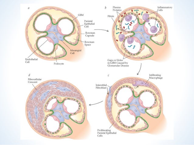 Glomerulonefritis Rápidamente Progresiva