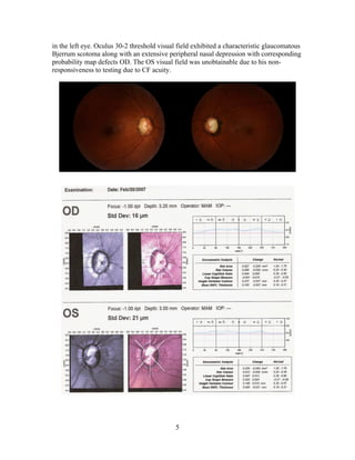 Glaucomatous Optic Atrophy | PDF