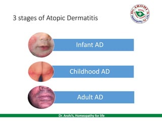 My clinical experience in cases of atopic dermaitis | PPT