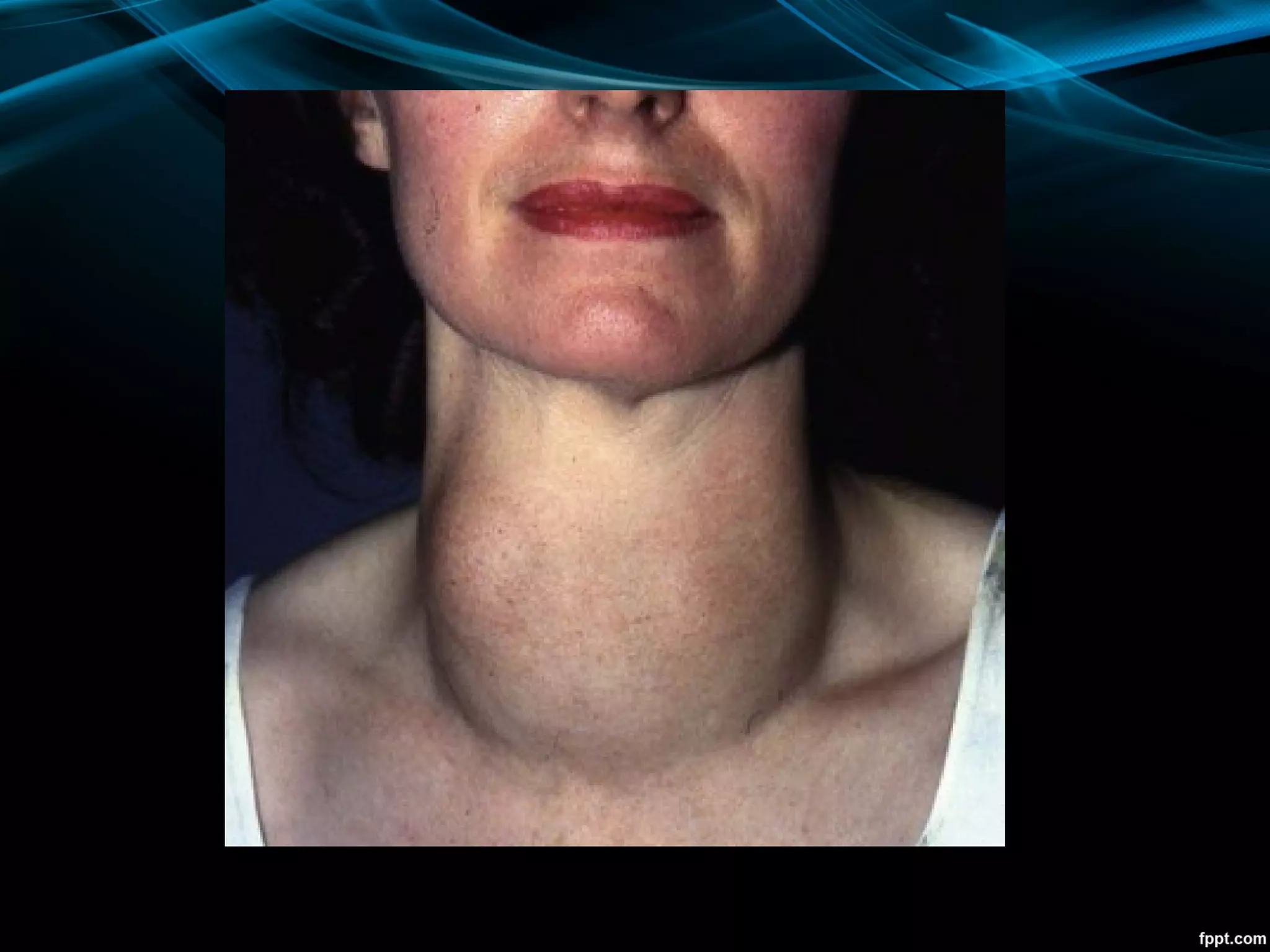 Goiter | PPT