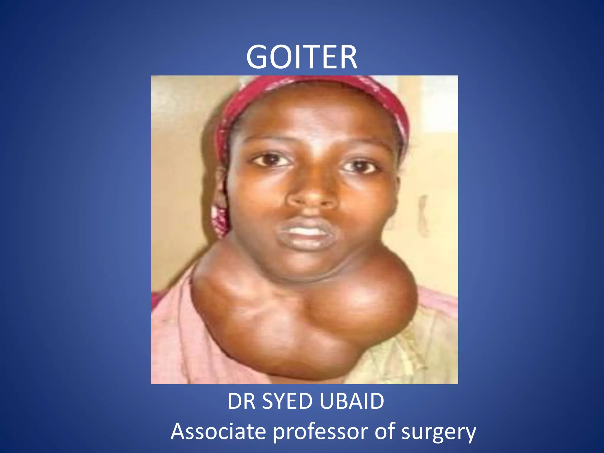 Goiter | PPTX