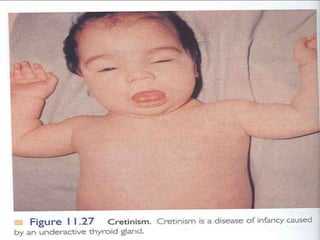 Goiter In Children
