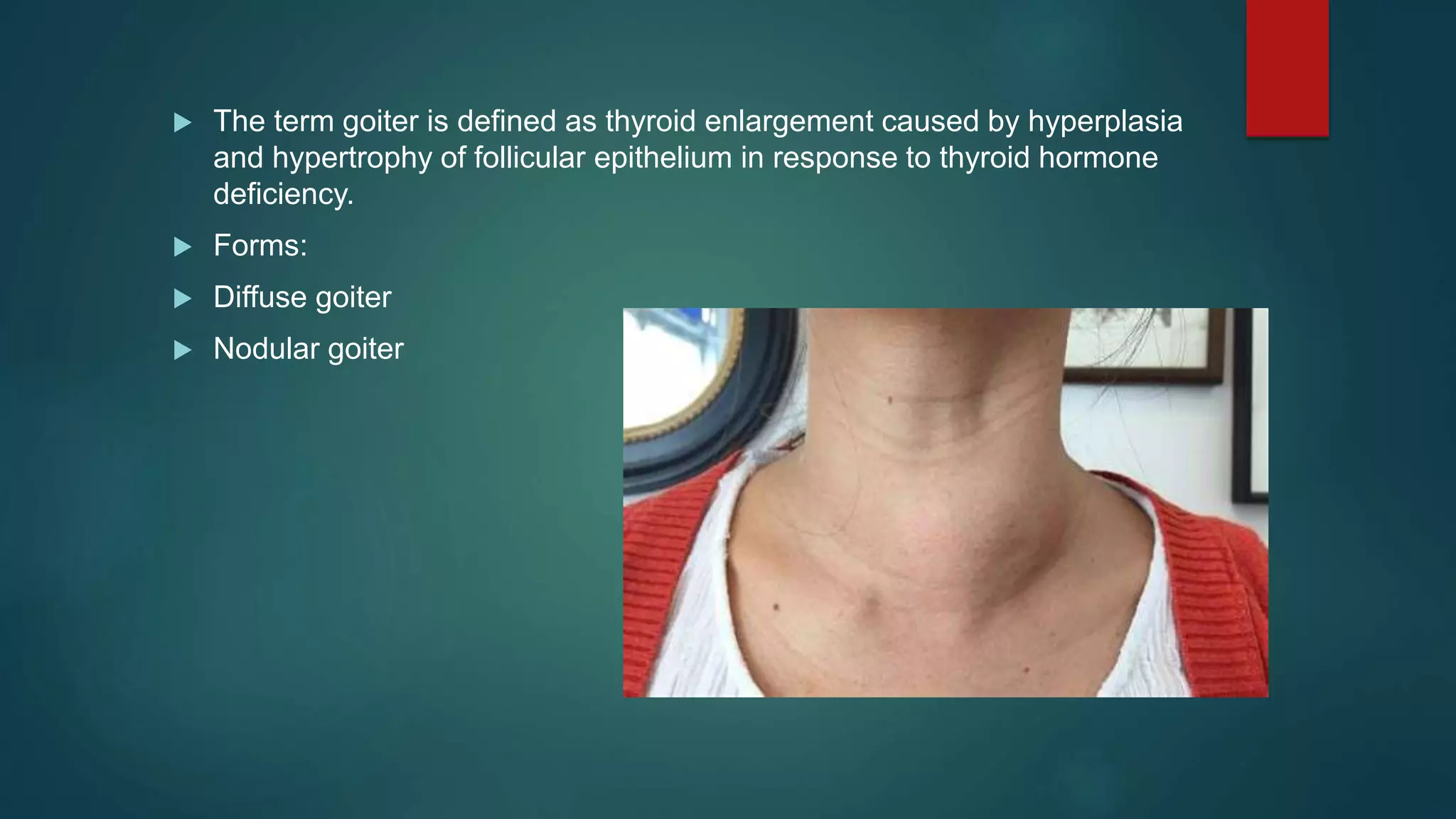 Goiter 2.pptx