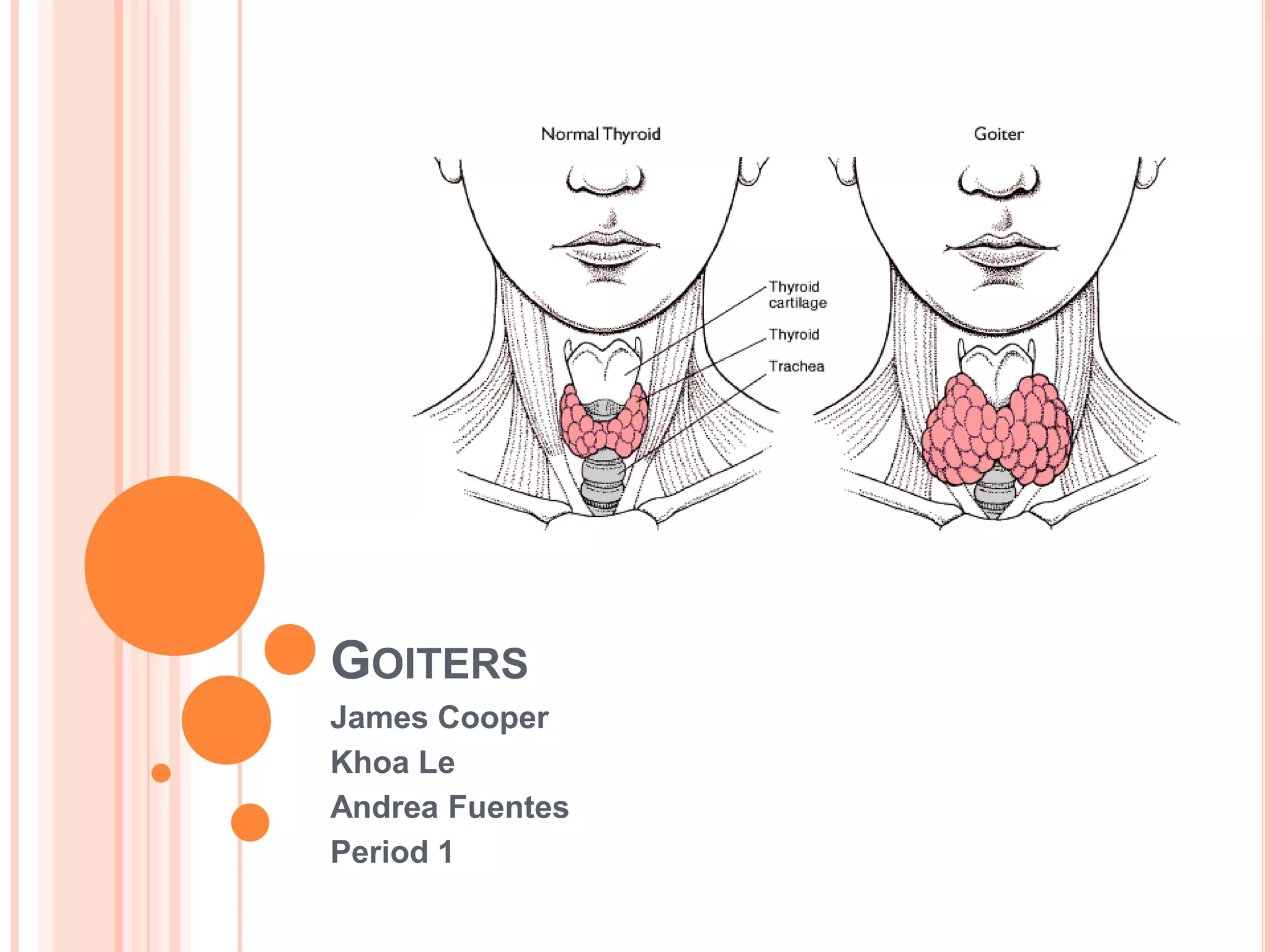 Goiters 120223070355-phpapp01[1] | PPTX