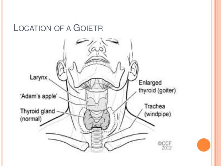 Goiters 120223070355-phpapp01[1]