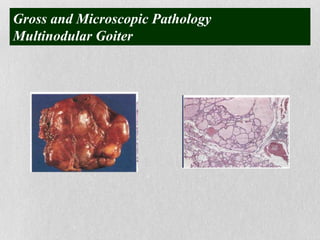 goitre.ppt