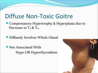 Goitre final year mbbs lecture | PPT