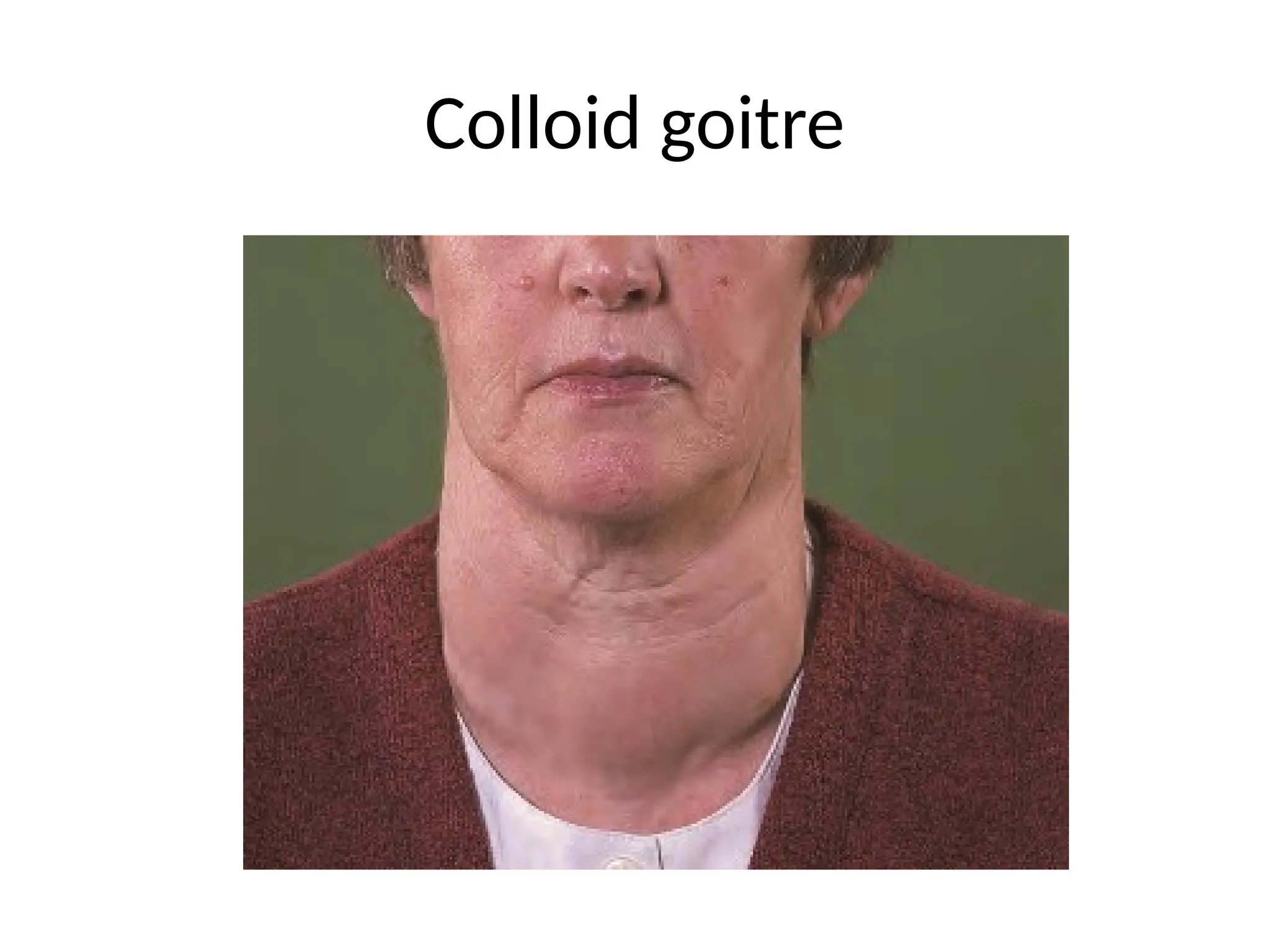 power point presentation on Goitre 1.pptx