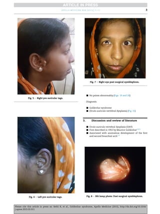 Goldenhar Syndrome | PDF