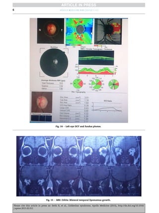 Goldenhar Syndrome | PDF