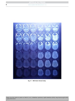 Goldenhar Syndrome | PDF