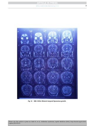 Goldenhar Syndrome Radiology