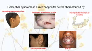 Goldenhar syndrome Ayurveda view and management | PDF