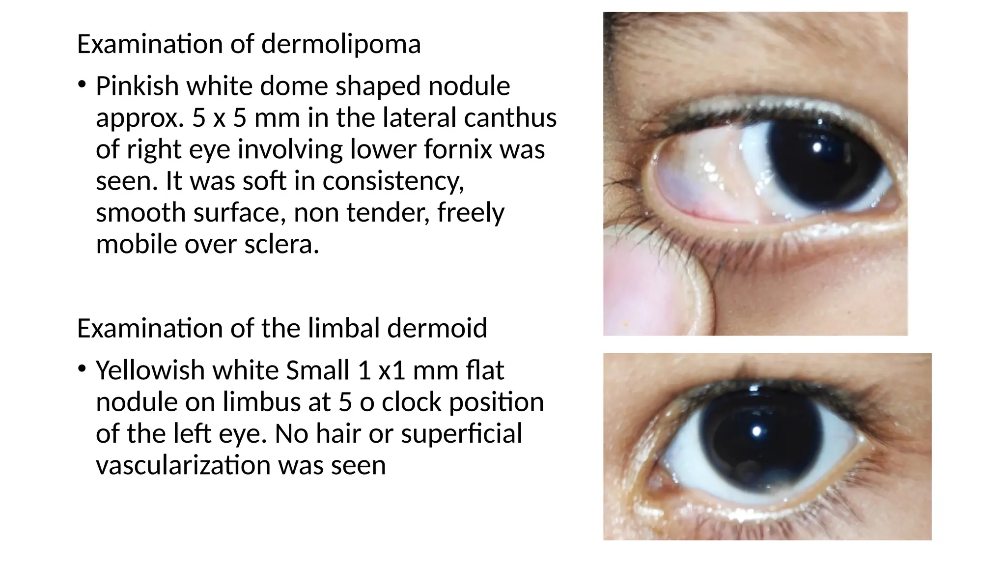 goldenhar syndrome[1] (1).pptx presentation | PPTX