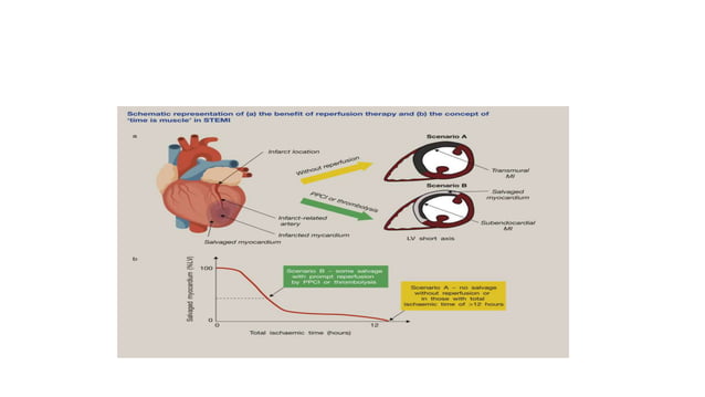GOLDEN HOUR IN ST Elevation Myocardialinfarction | PPTX | Heart and ...