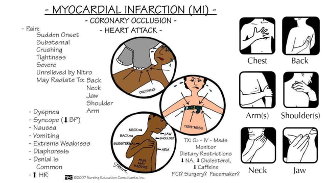 GOLDEN HOUR IN ST Elevation Myocardialinfarction | PPTX | Heart and ...