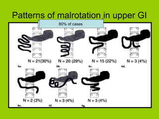 Golden rules for diagnosing intestinal malrotation | PPT