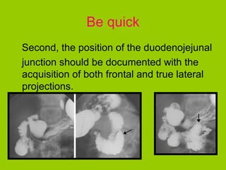 Golden rules for diagnosing intestinal malrotation | PPT