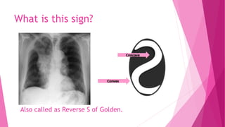 Golden S sign | PPTX | Lung and Respiratory Health | Diseases and ...