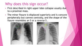 Golden S sign | PPTX | Lung and Respiratory Health | Diseases and ...
