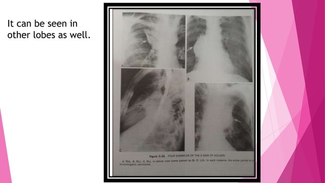 Golden S sign | PPTX | Lung and Respiratory Health | Diseases and ...