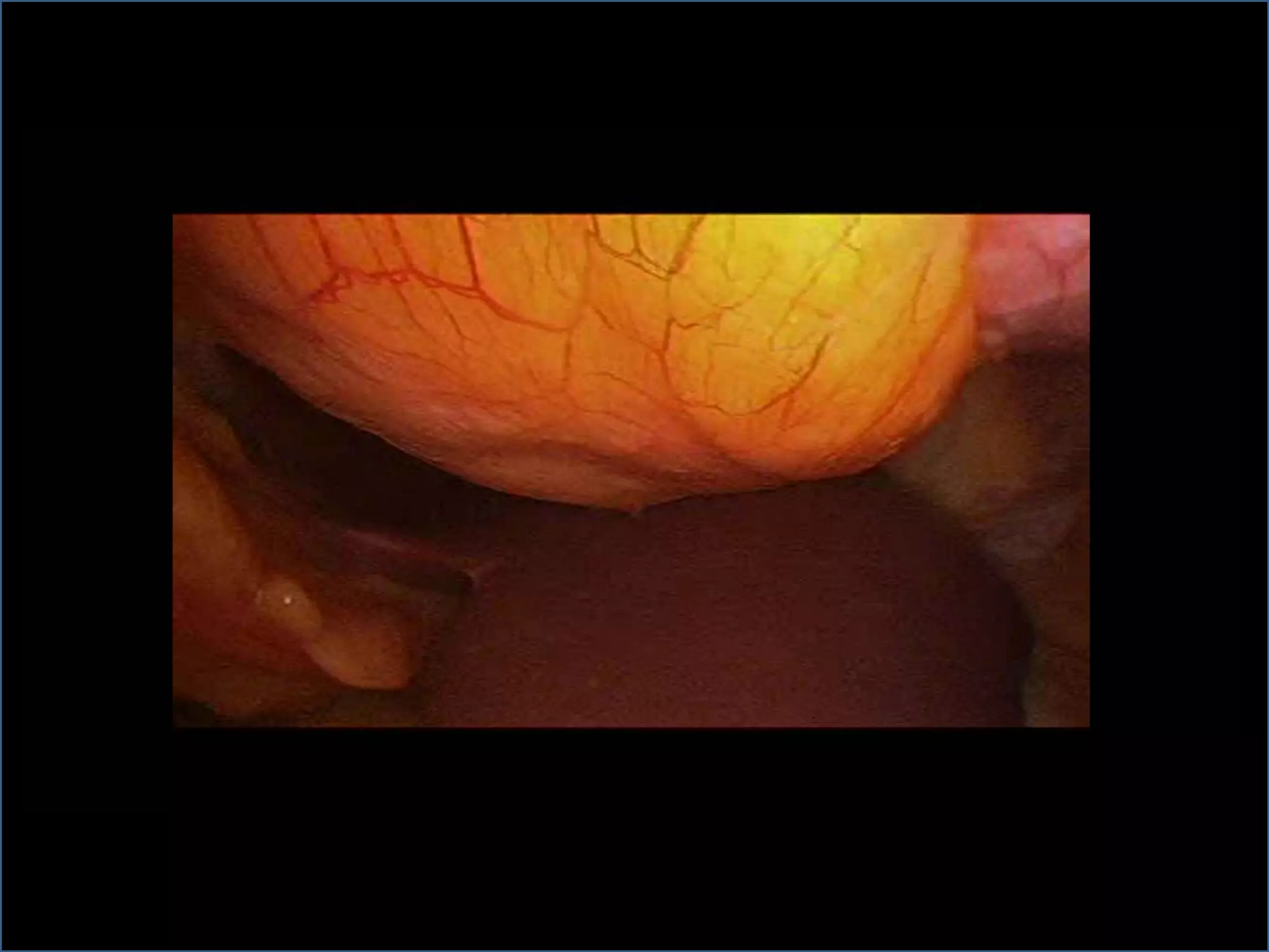 Golden steps to perform laparoscopic sleeve gastrectomy | PPTX