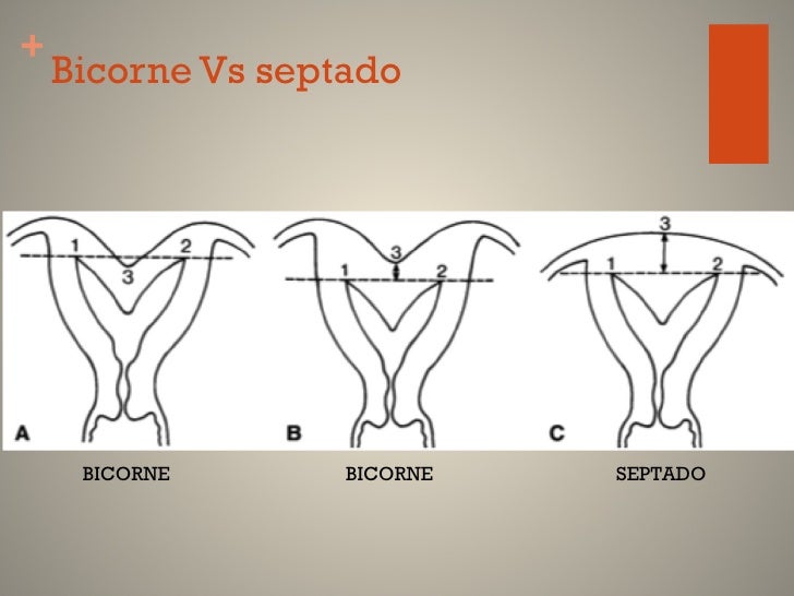 Malformaciones uterovaginales