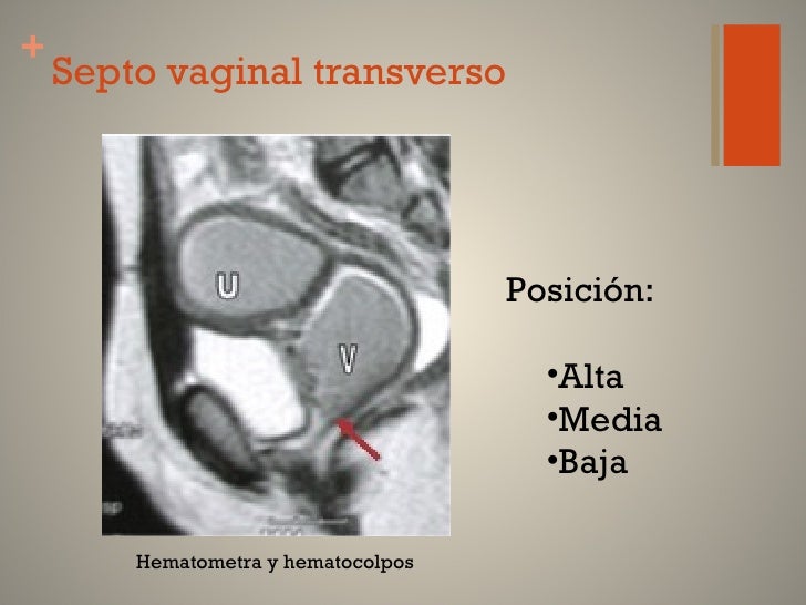 Malformaciones uterovaginales