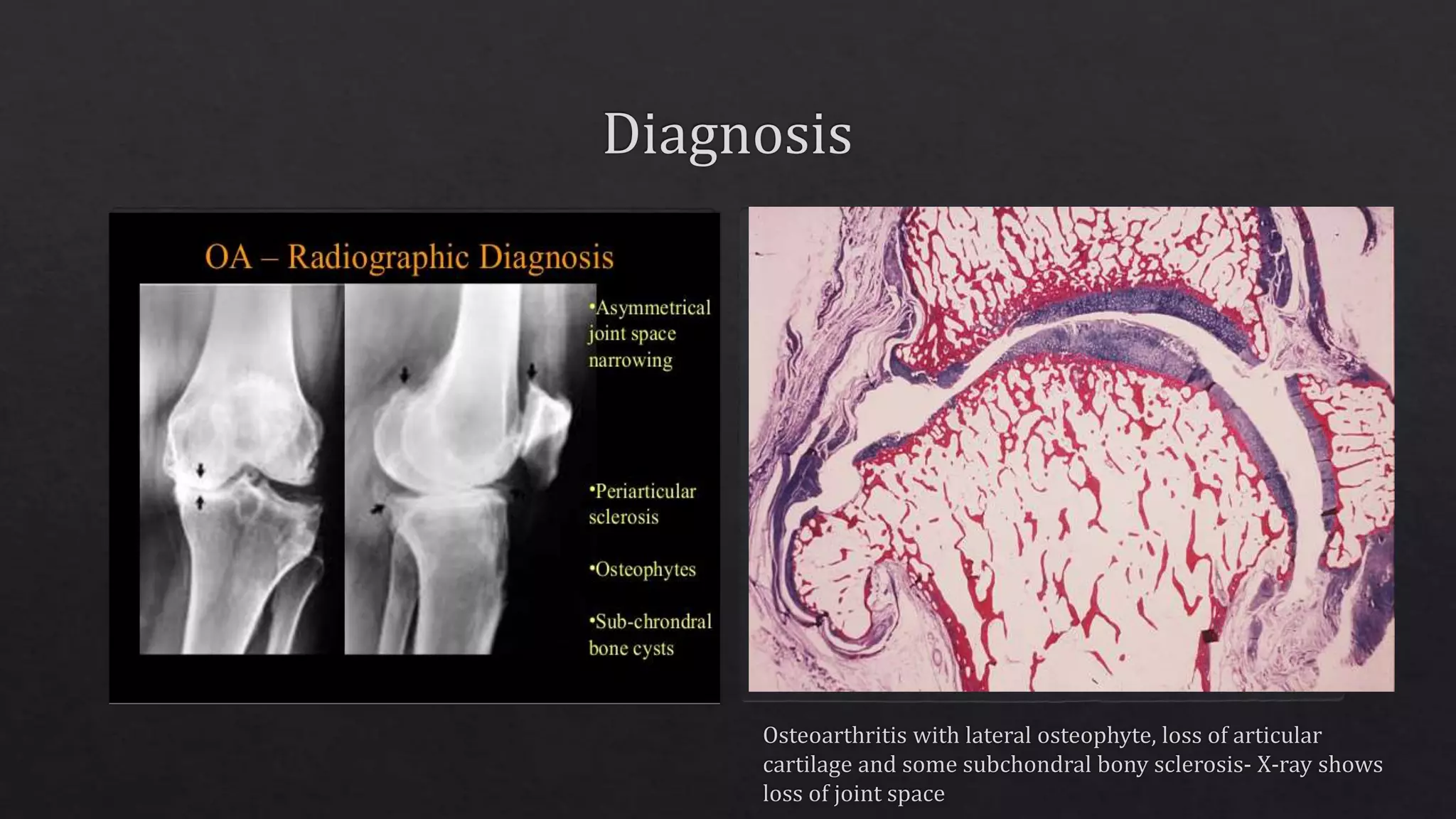 Gonarthrosis and knee replacement | PPTX