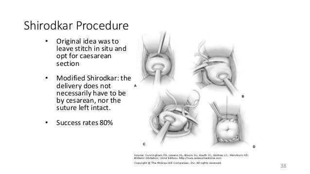 Management of Cervical Incompetence