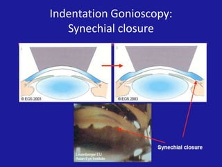 Gonioscopy | PPTX