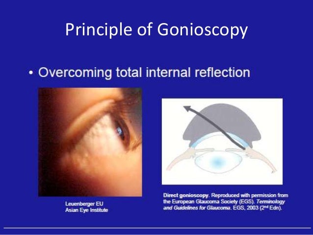 Gonioscopy
