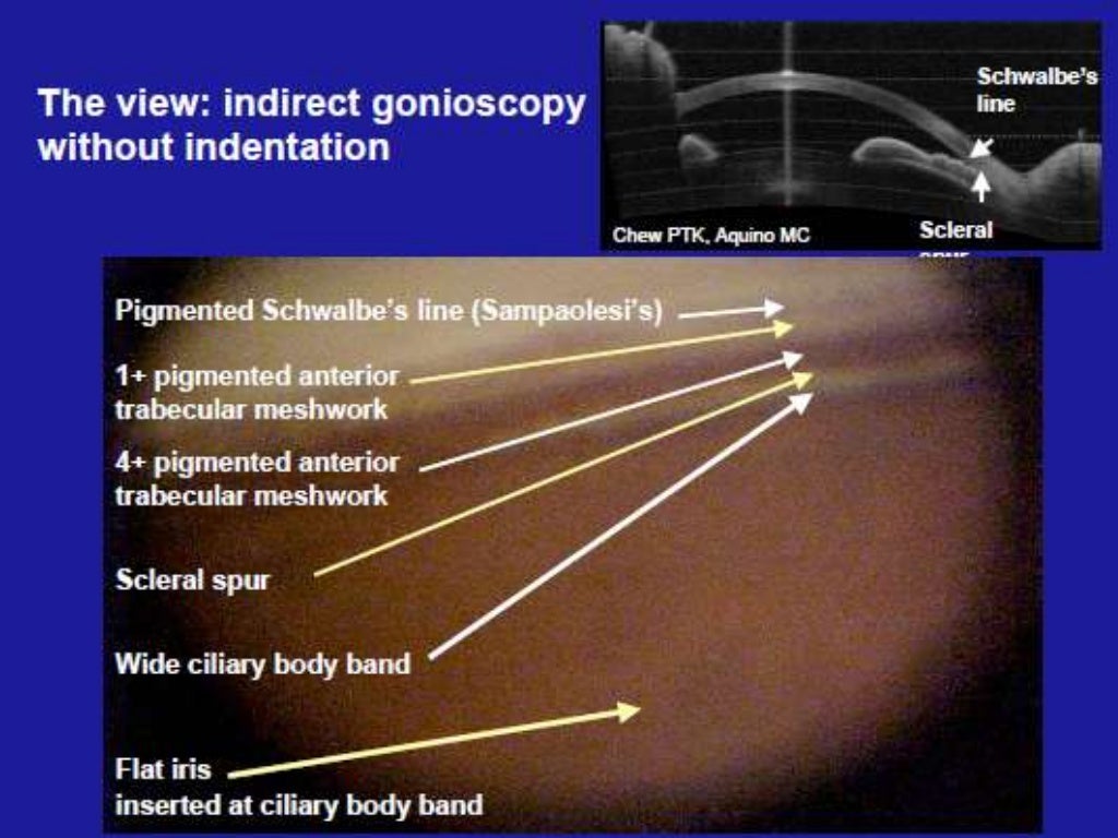 Gonioscopy