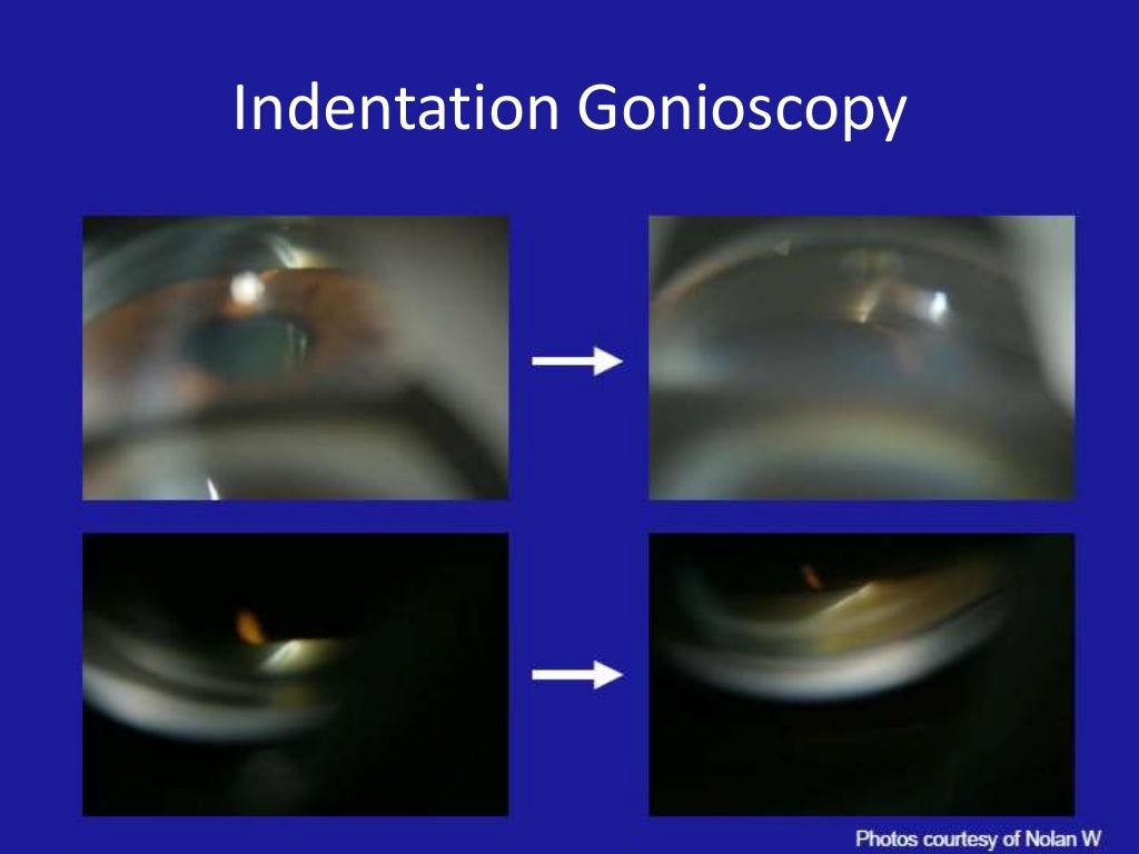 Gonioscopy