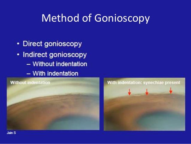 Gonioscopy