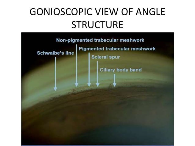 Gonioscopy | PPT