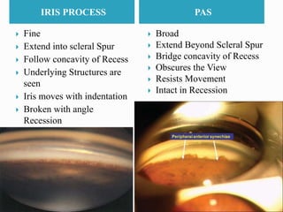 Iris Processes Gonioscopy Angle