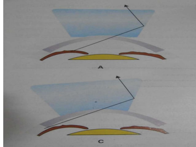 Gonioscopy: gonioscopic lenses, principle and clinical aspects | PPTX