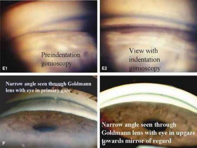 Gonioscopy: gonioscopic lenses, principle and clinical aspects | PPTX