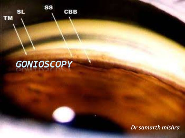 Gonioscopy: gonioscopic lenses, principle and clinical aspects | PPT