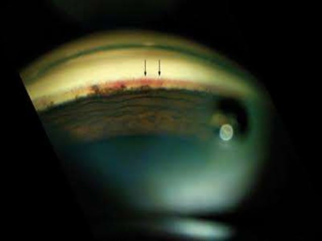 Gonioscopy: gonioscopic lenses, principle and clinical aspects
