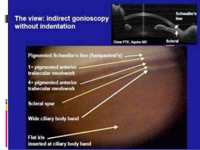 Gonioscopy: gonioscopic lenses, principle and clinical aspects