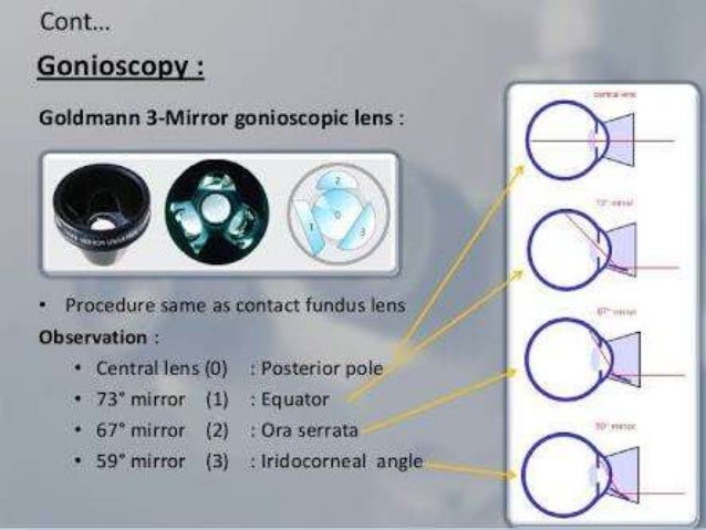 Gonioscopy: gonioscopic lenses, principle and clinical aspects