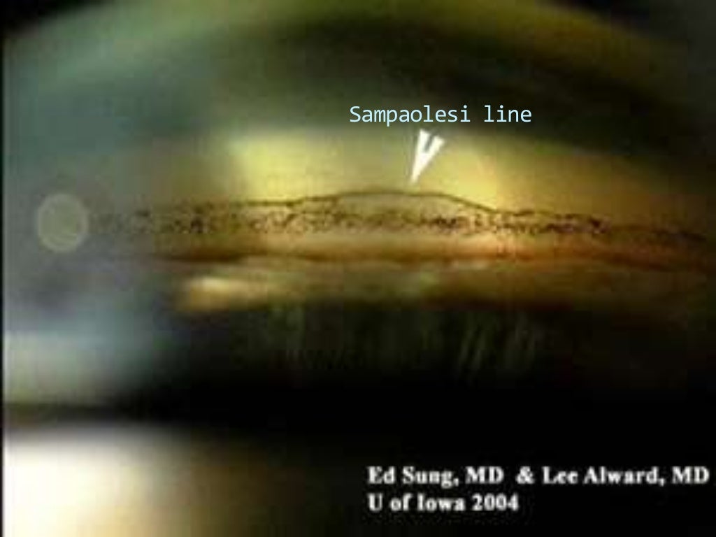 Gonioscopy: gonioscopic lenses, principle and clinical aspects