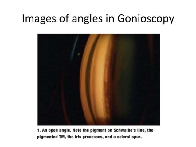Gonioscopy | PPTX