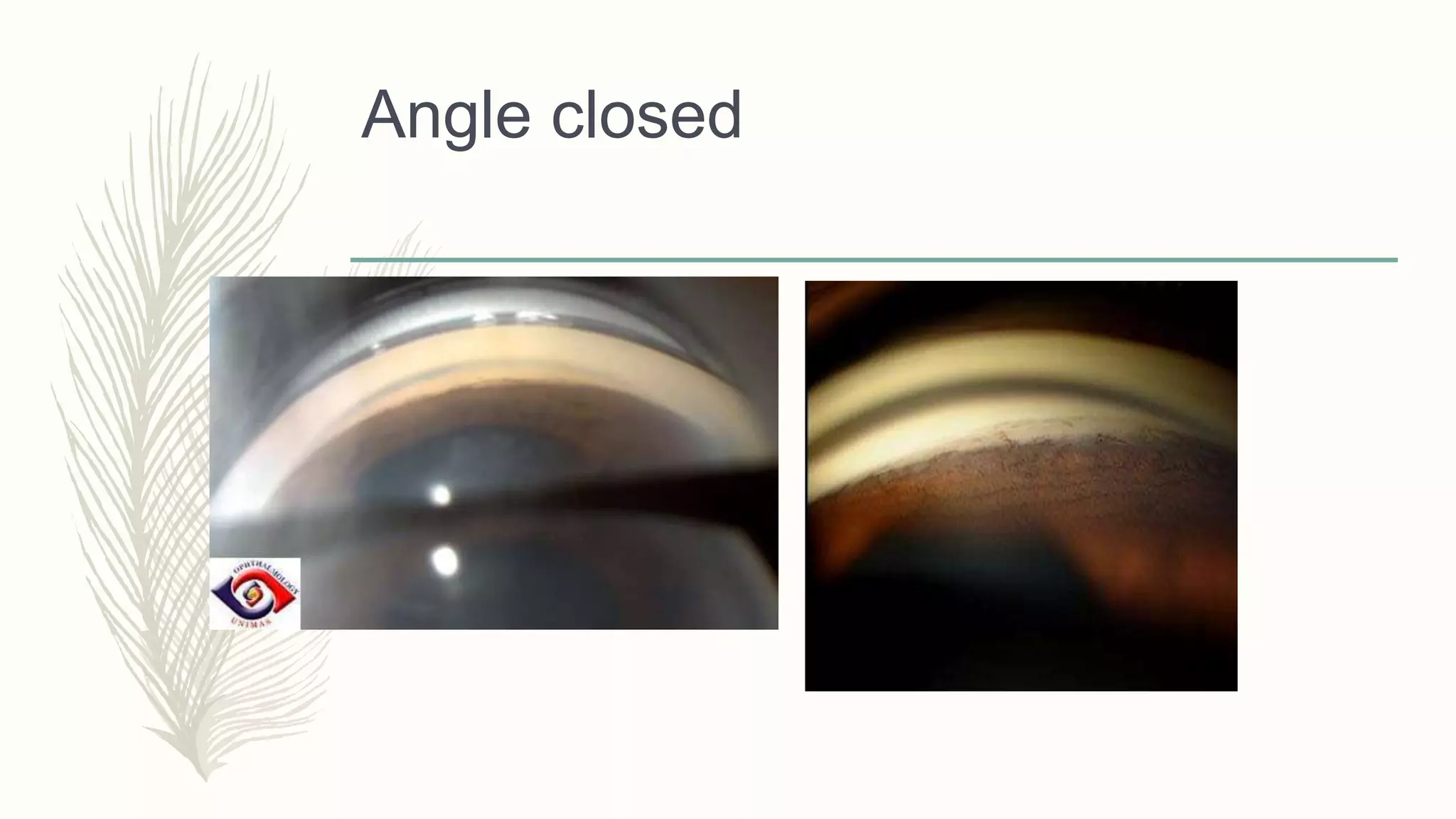Gonioscopy | PPTX