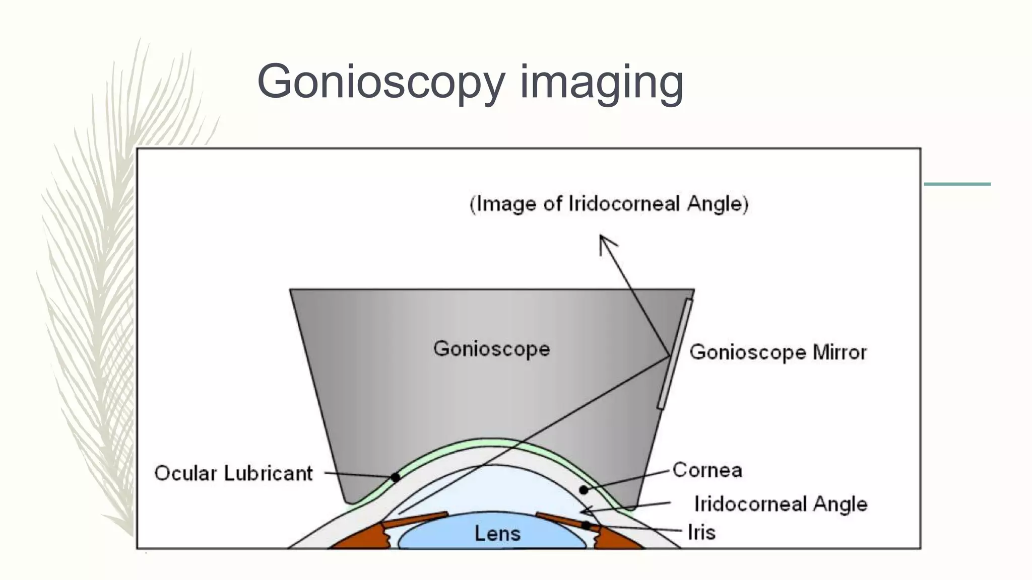 Gonioscopy | PPTX