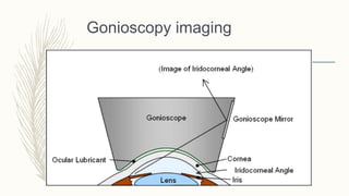 Gonioscopy | PPT
