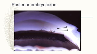 Posterior Embryotoxon Gonioscopy